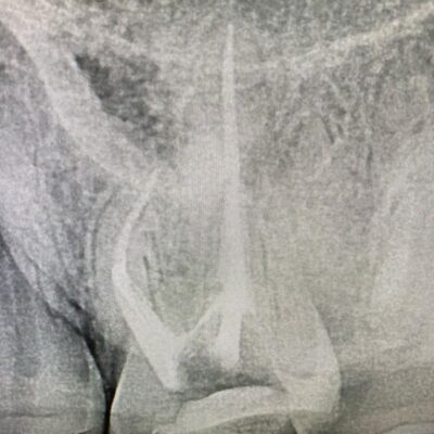 Emergency Endodontics Root Canal Therapy | Dental Care Services | San Diego